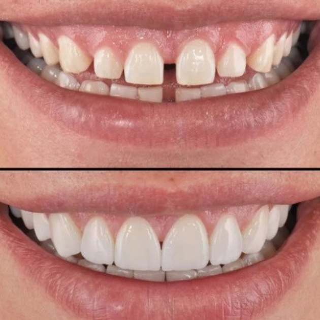 Виниры зубные Perfect Smile Veneers сменные белые от продавца: Riamon ...